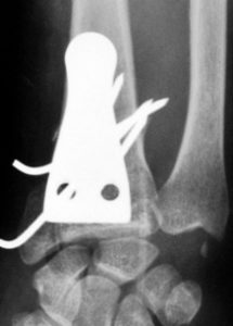 Les fractures du poignet - Orthopédie Brest